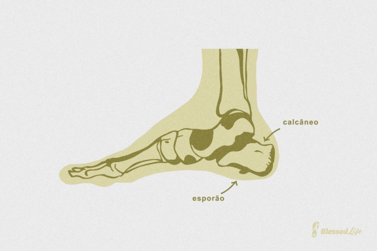 A diferença entre esporão do calcâneo e fascite plantar - Blog Blessed Life
